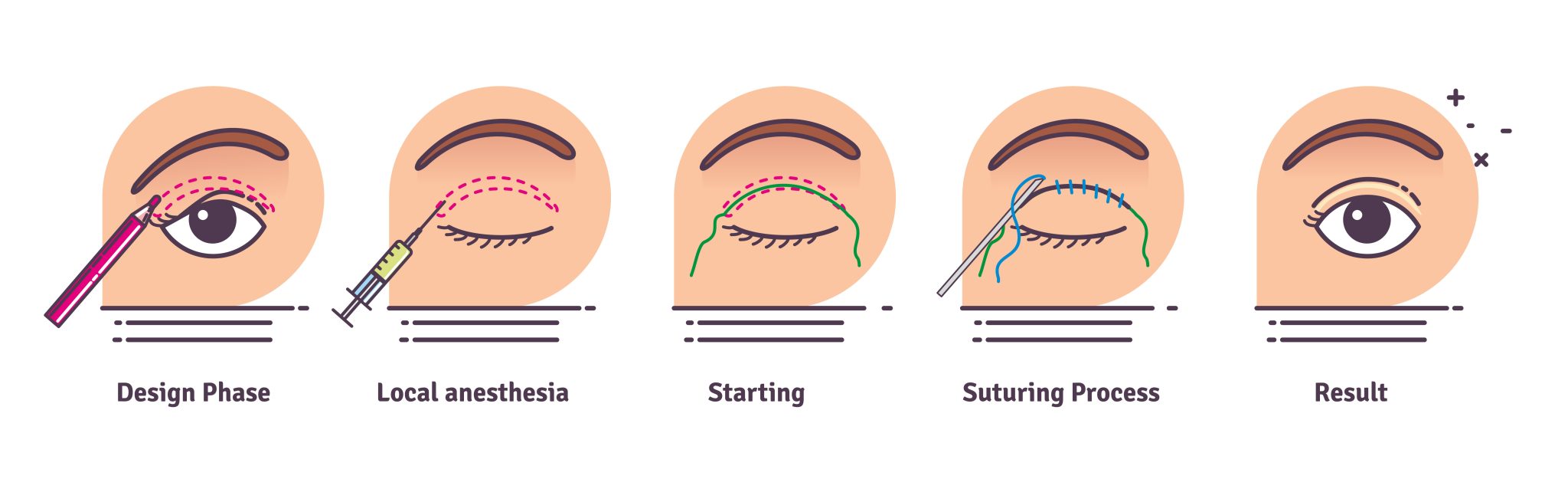 Upper Blepharoplasty - Eagle Eye Aesthetic